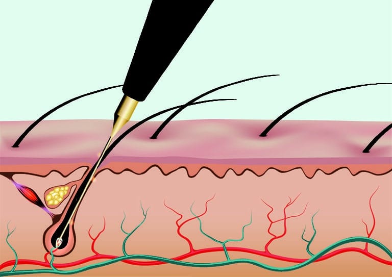 About Electrolysis | Juicy Roots Electrolysis | Roseville, CA